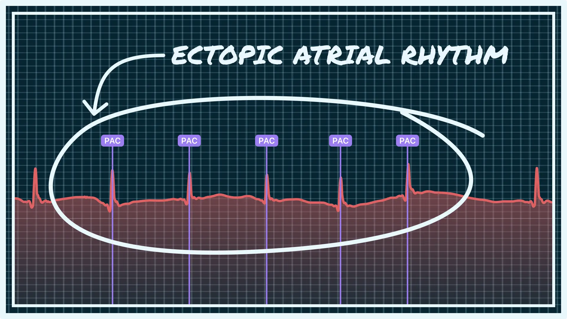 What Ectopic Atrial Rhythm Looks Like on Your Watch ECG | Qaly